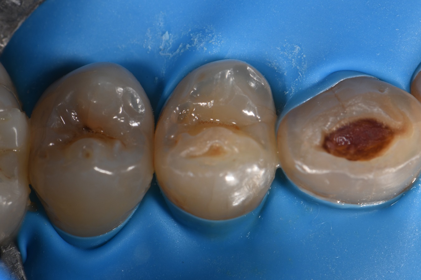Chameleon Composite Resin Restorations Chameleon Composite Resin ...