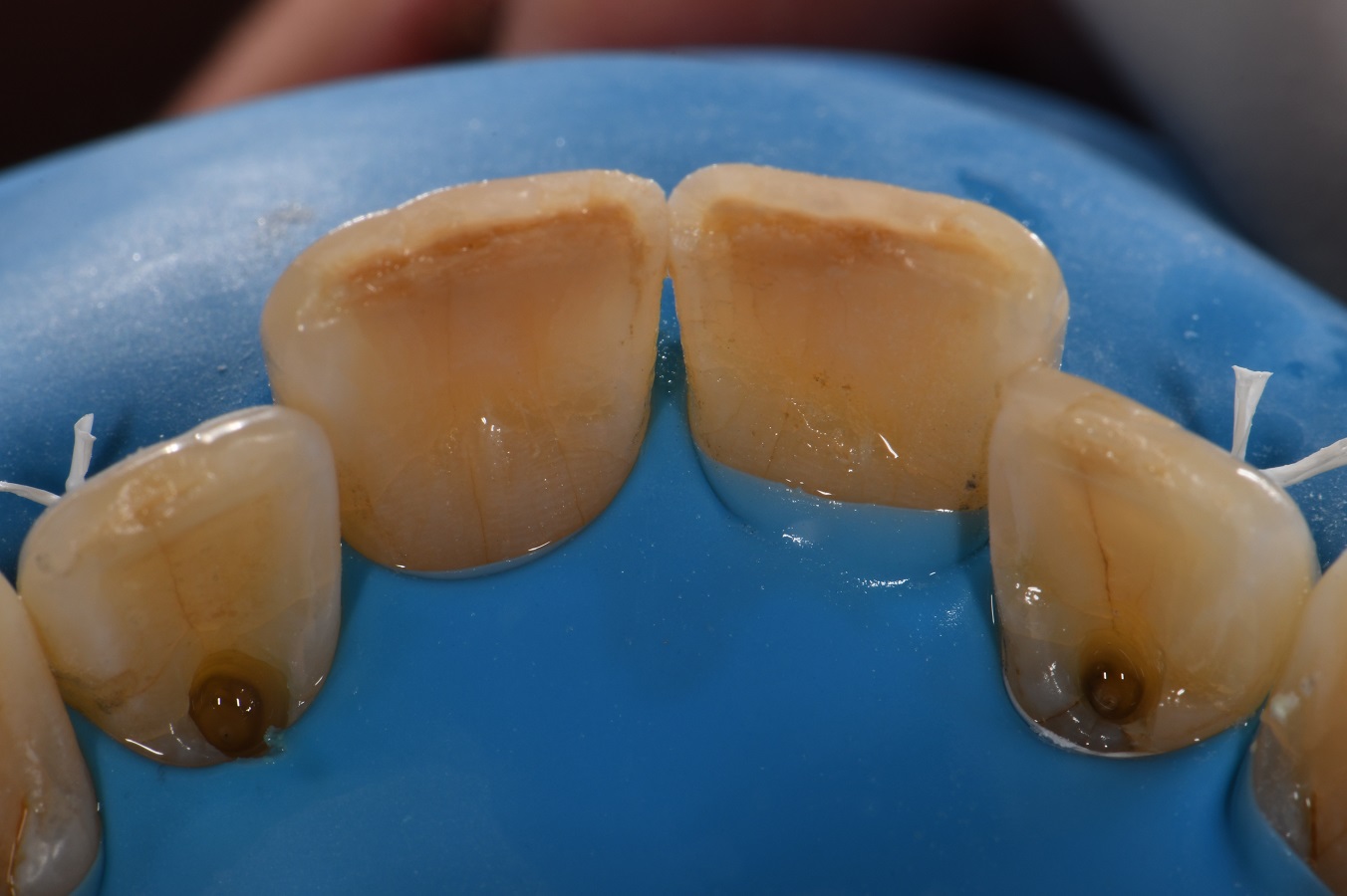 Amalgam Replacement Restorations