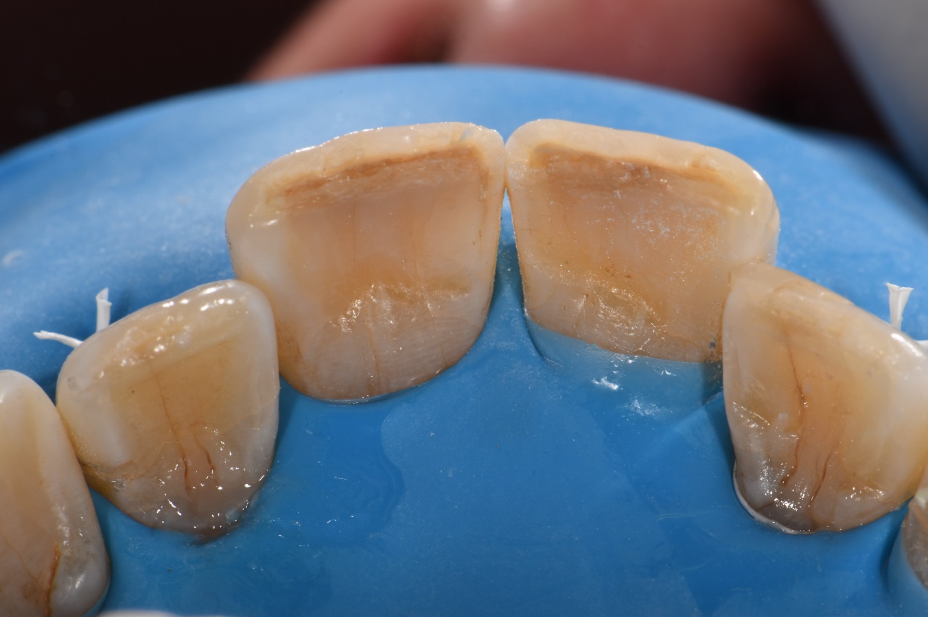 Amalgam Replacement Restorations