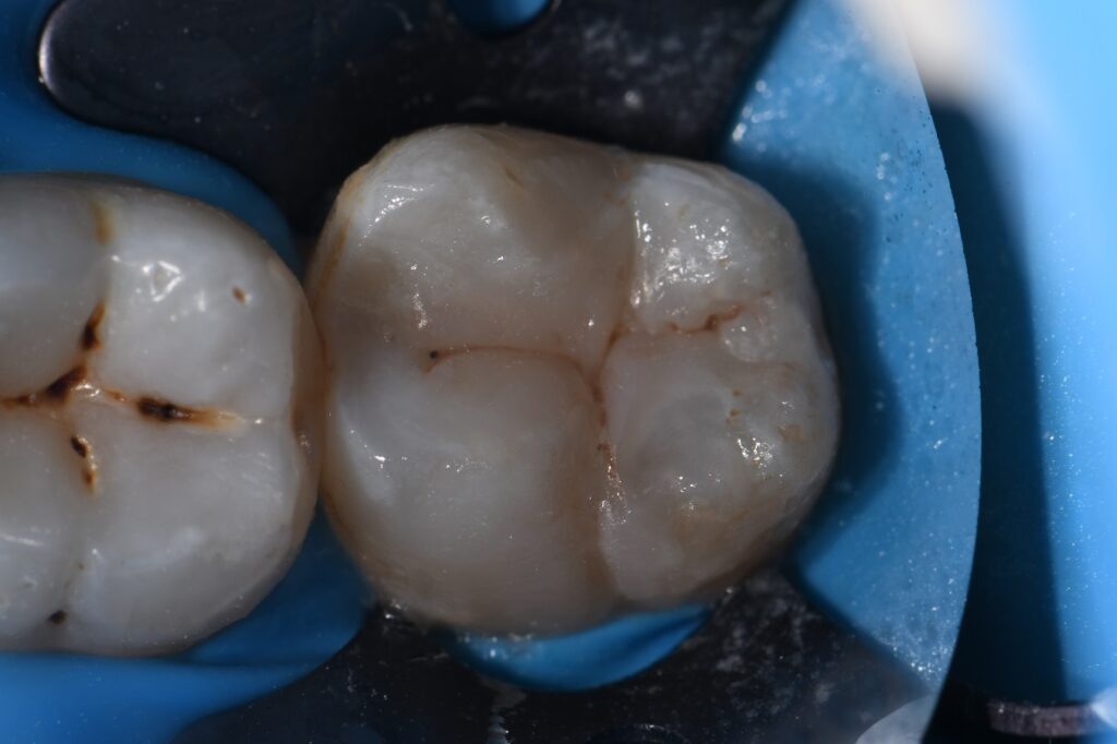 Wisdom Tooth Composite Restoration
