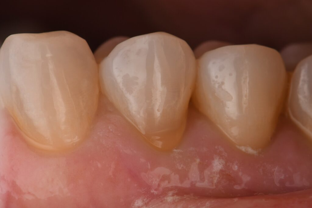 Class V seamless restoration Class V seamless restoration