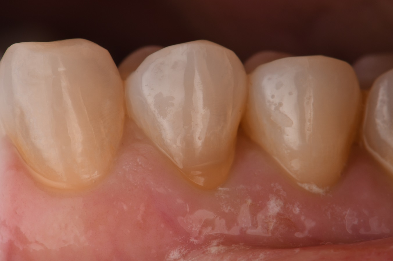 Class V seamless restoration Class V seamless restoration