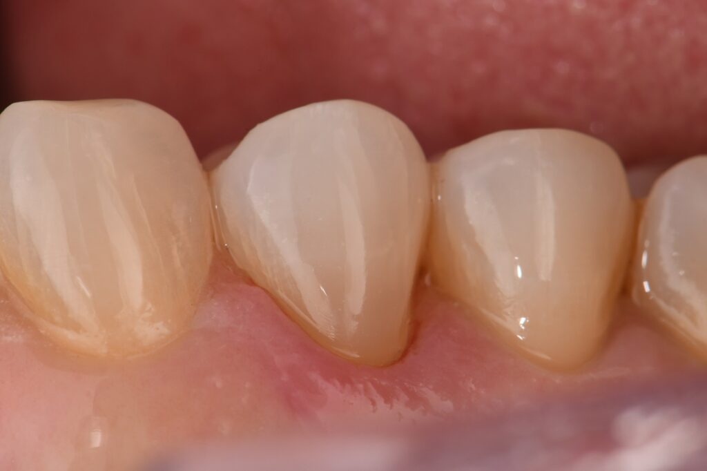 Class V seamless restoration Class V seamless restoration