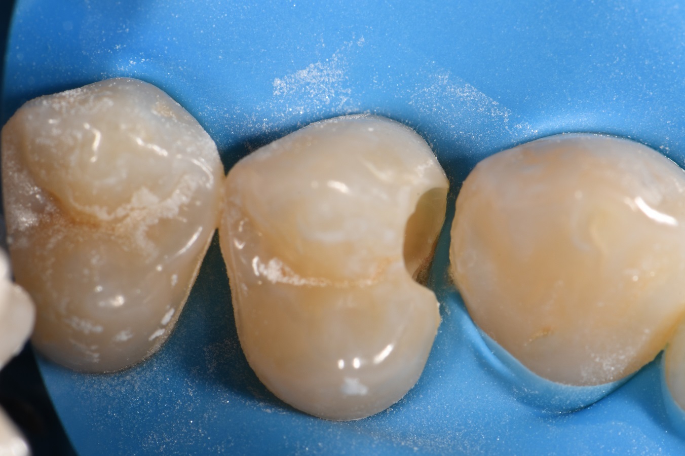Premolar Marginal Ridge Premolar Marginal Ridge