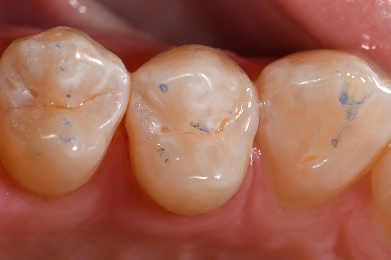 Premolar Marginal Ridge Premolar Marginal Ridge