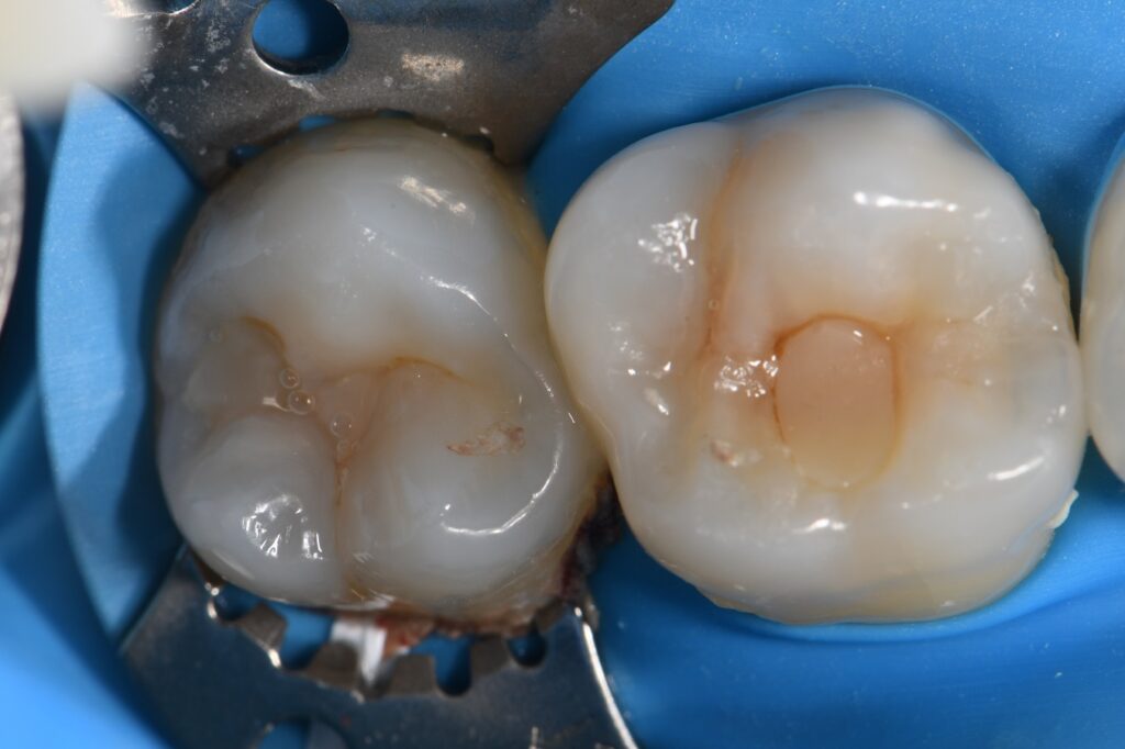 Recurrent caries around old composites Recurrent caries around old ...