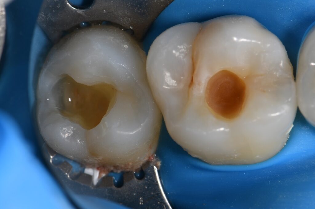 Recurrent caries around old composites Recurrent caries around old ...