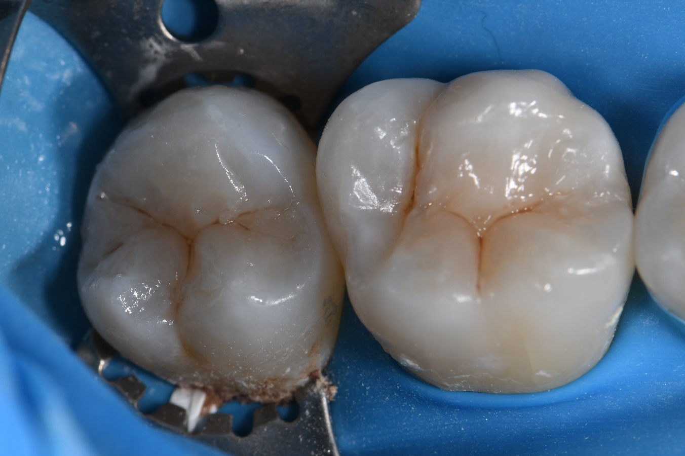 Recurrent caries around old composites Recurrent caries around old ...