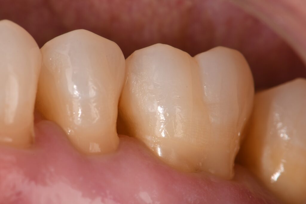 Root abrasion reversed Root abrasion reversed