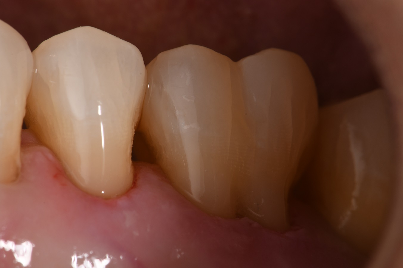 Root abrasion reversed Root abrasion reversed