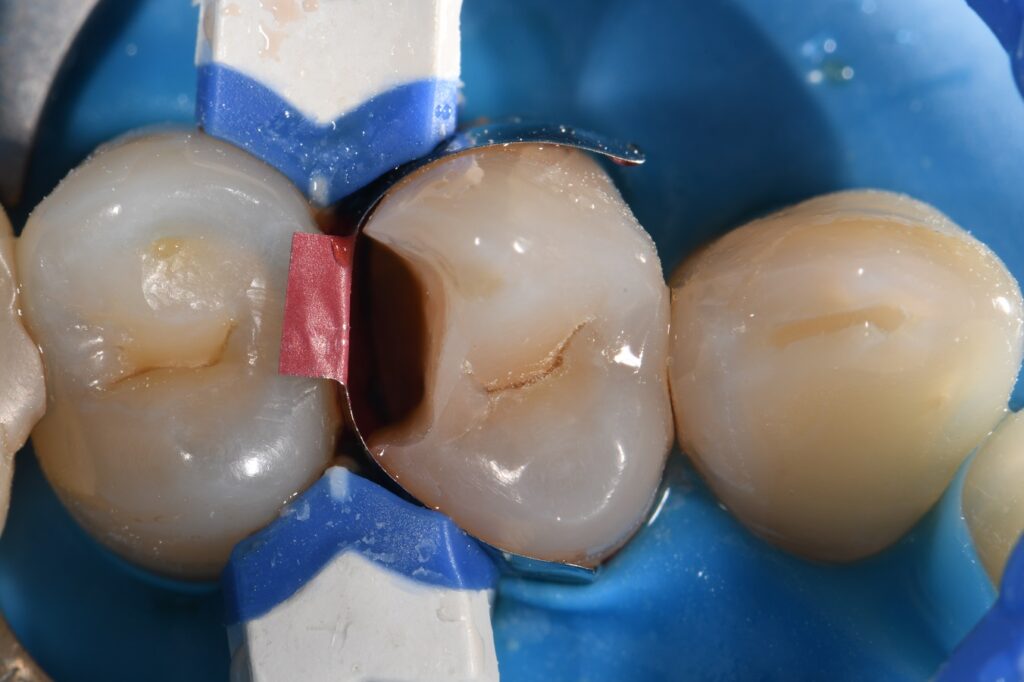 Composite Class II Restoration