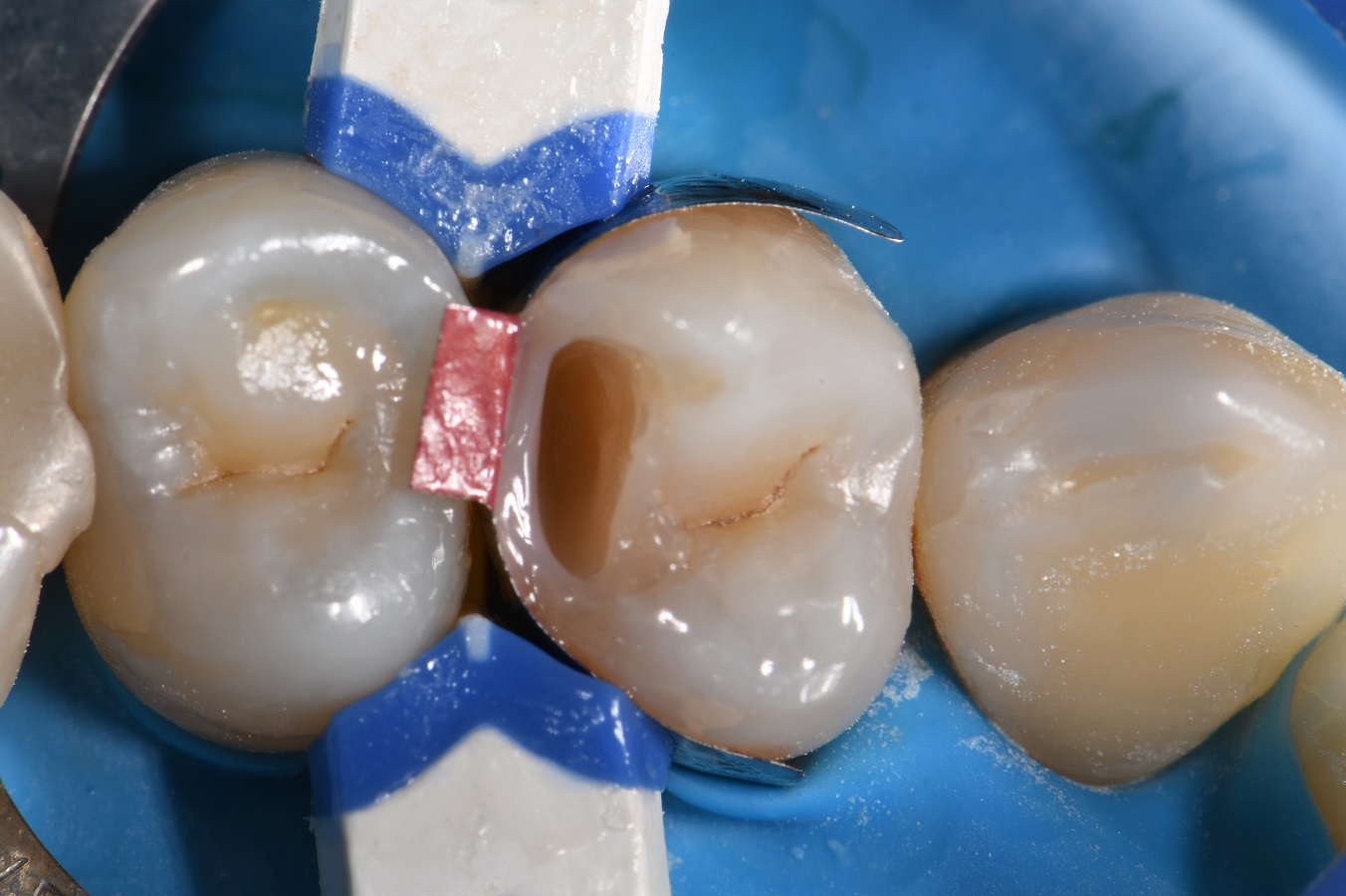 Composite Class II Restoration