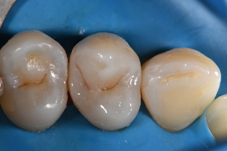 Composite Class II Restoration