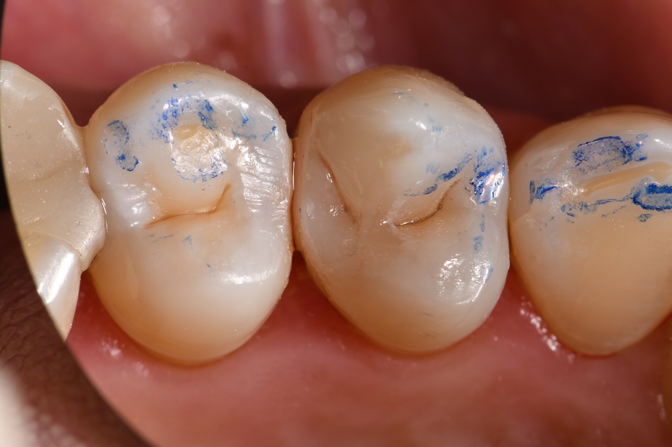 Composite Class II Restoration