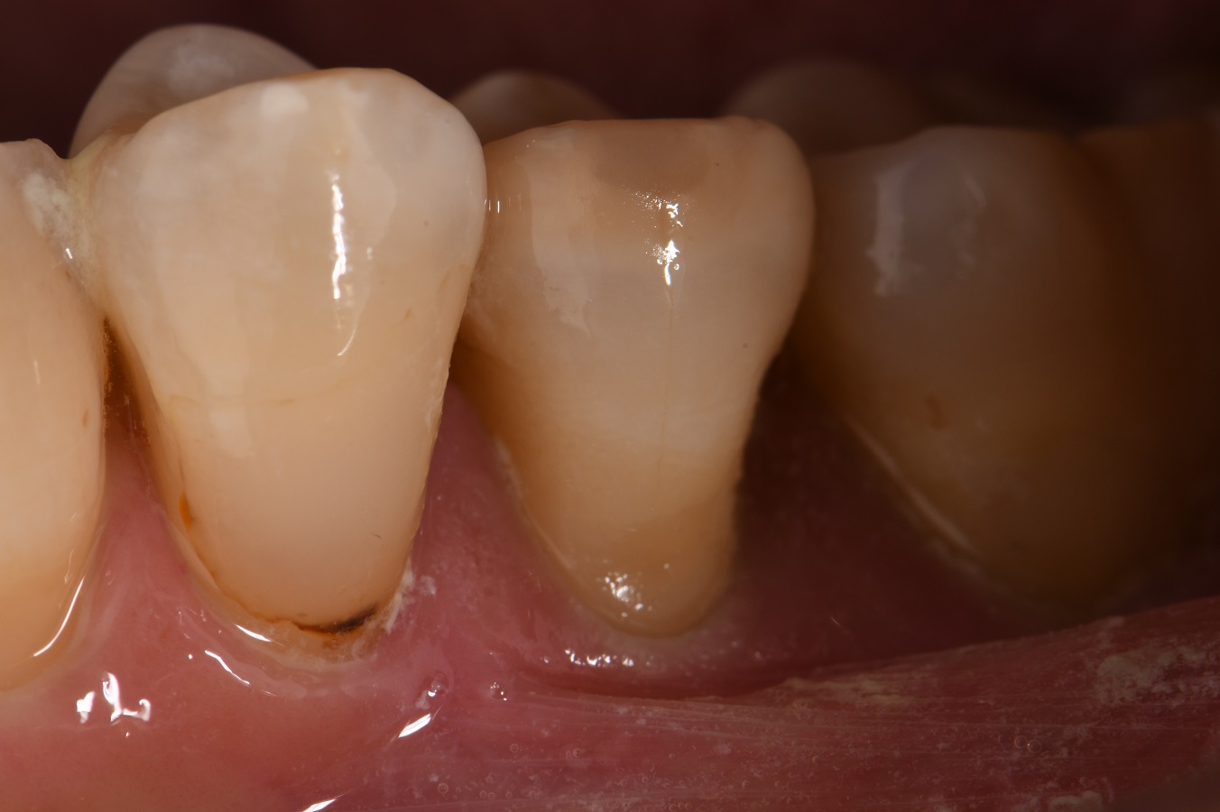 Protecting the teeth through composite