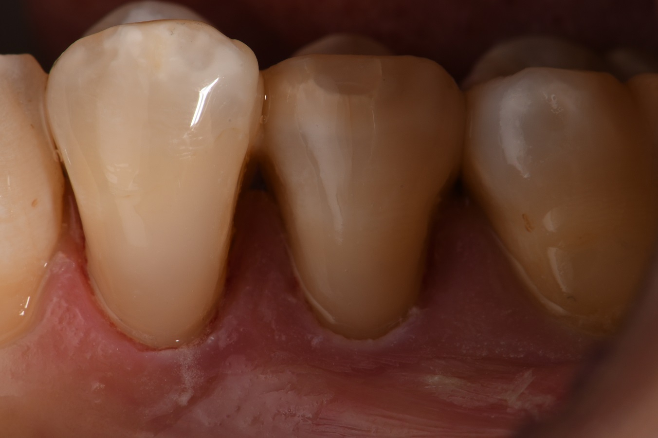 Protecting the teeth through composite