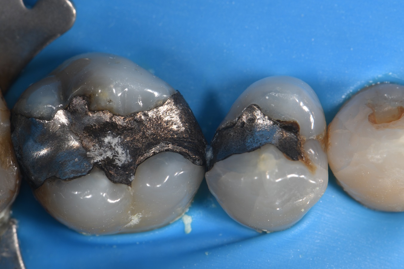 Garrison Wide Prep Ring | Kerr Simplishade Medium