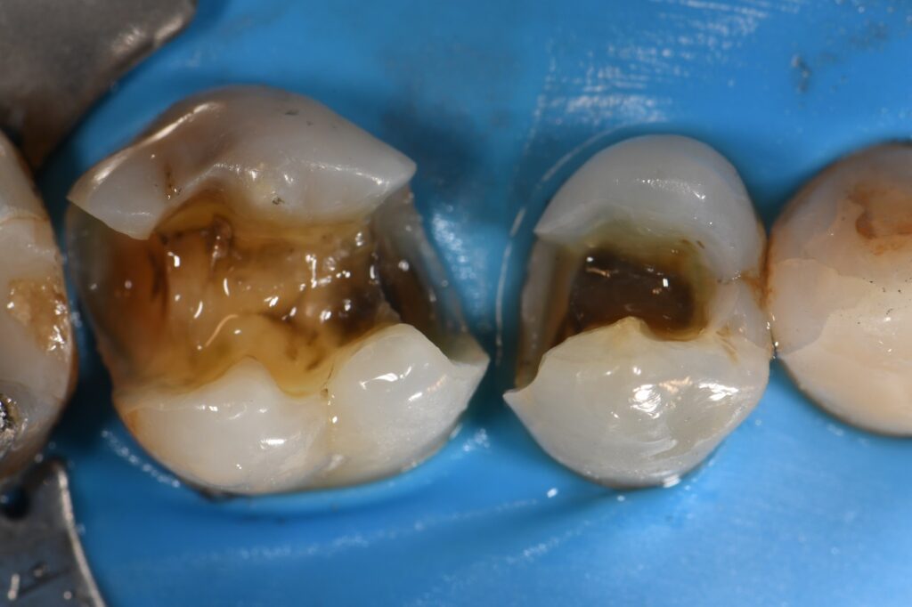 Garrison Wide Prep Ring | Kerr Simplishade Medium