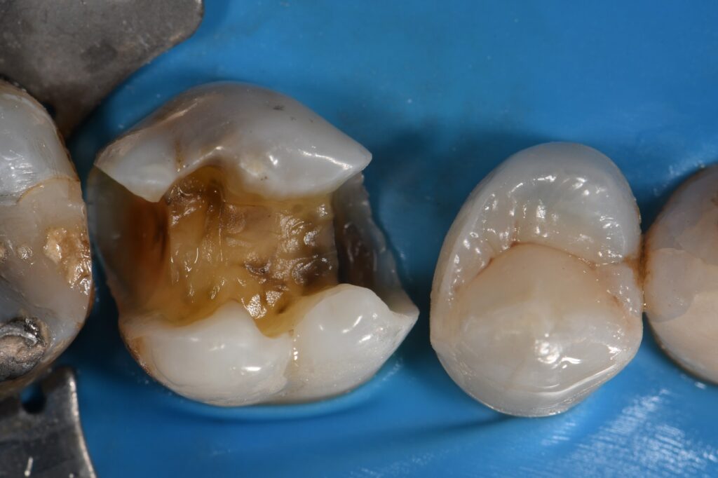 Garrison Wide Prep Ring | Kerr Simplishade Medium