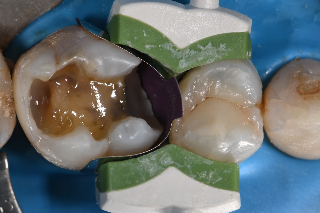 Garrison Wide Prep Ring | Kerr Simplishade Medium