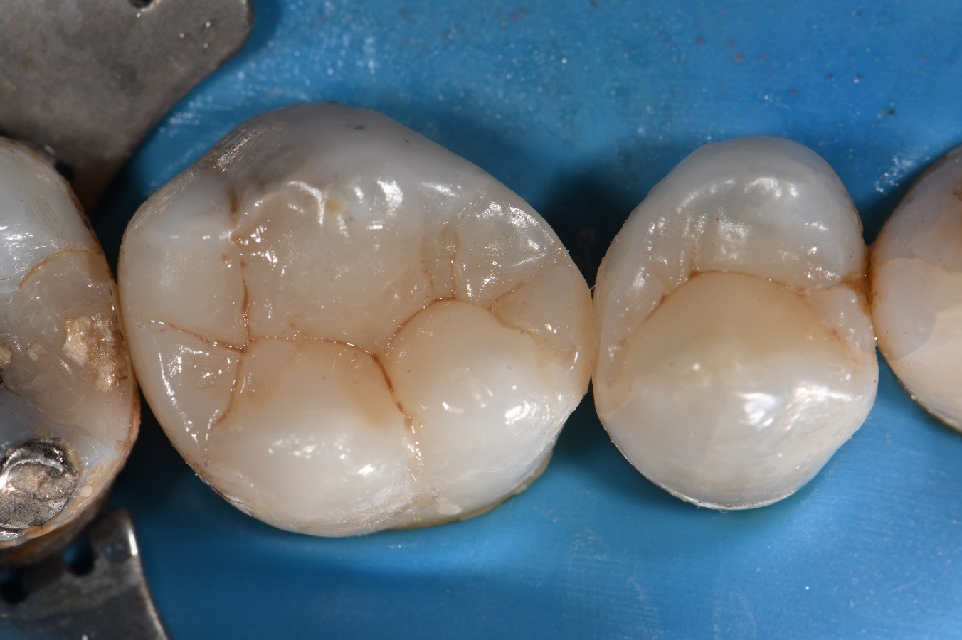 Garrison Wide Prep Ring | Kerr Simplishade Medium