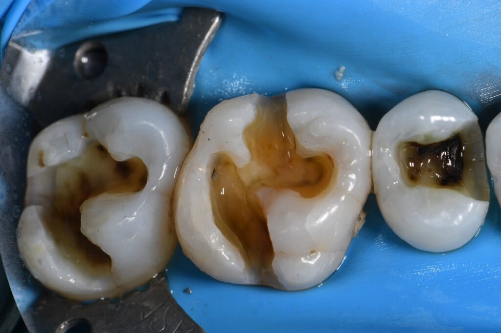 Complex Composite Resin Complex Composite Resin