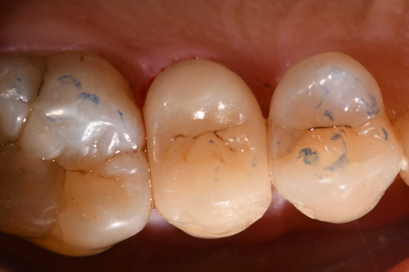 Complex Reconstruction with Porcelain Crown