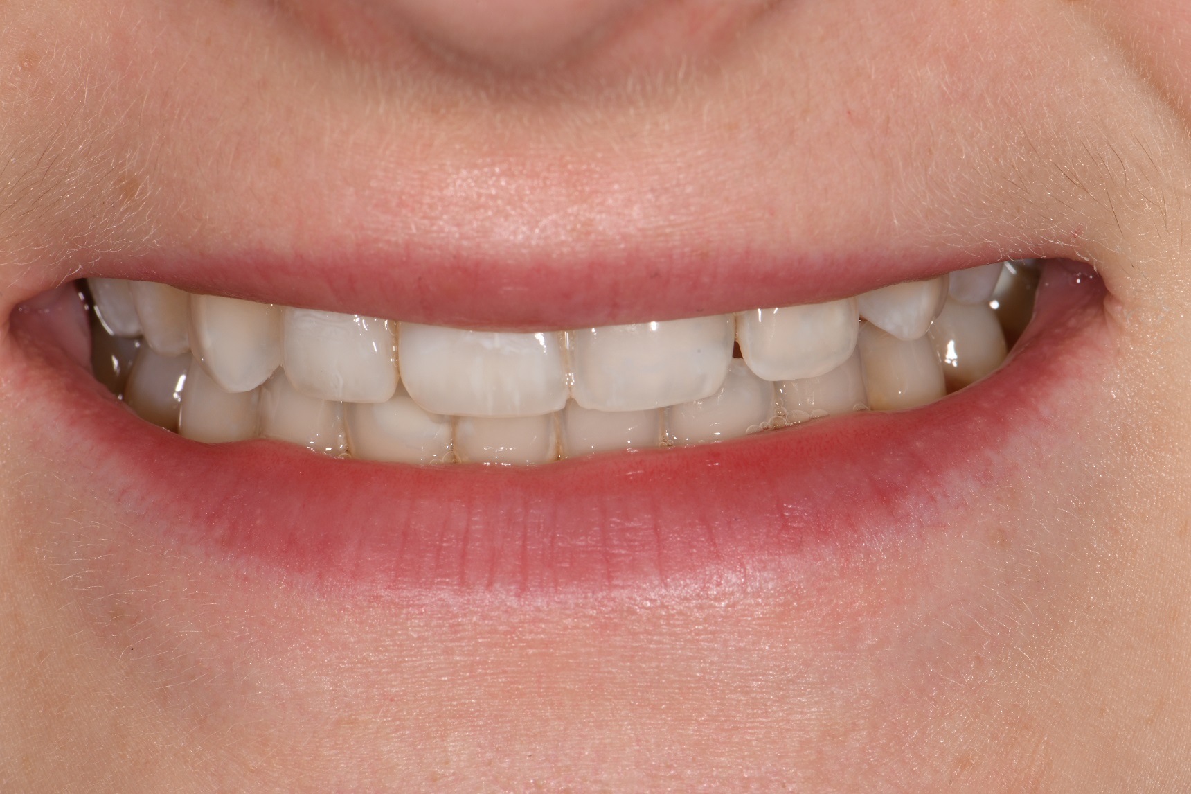 Correction of Incisor Hypomineralization Correction of Incisor ...