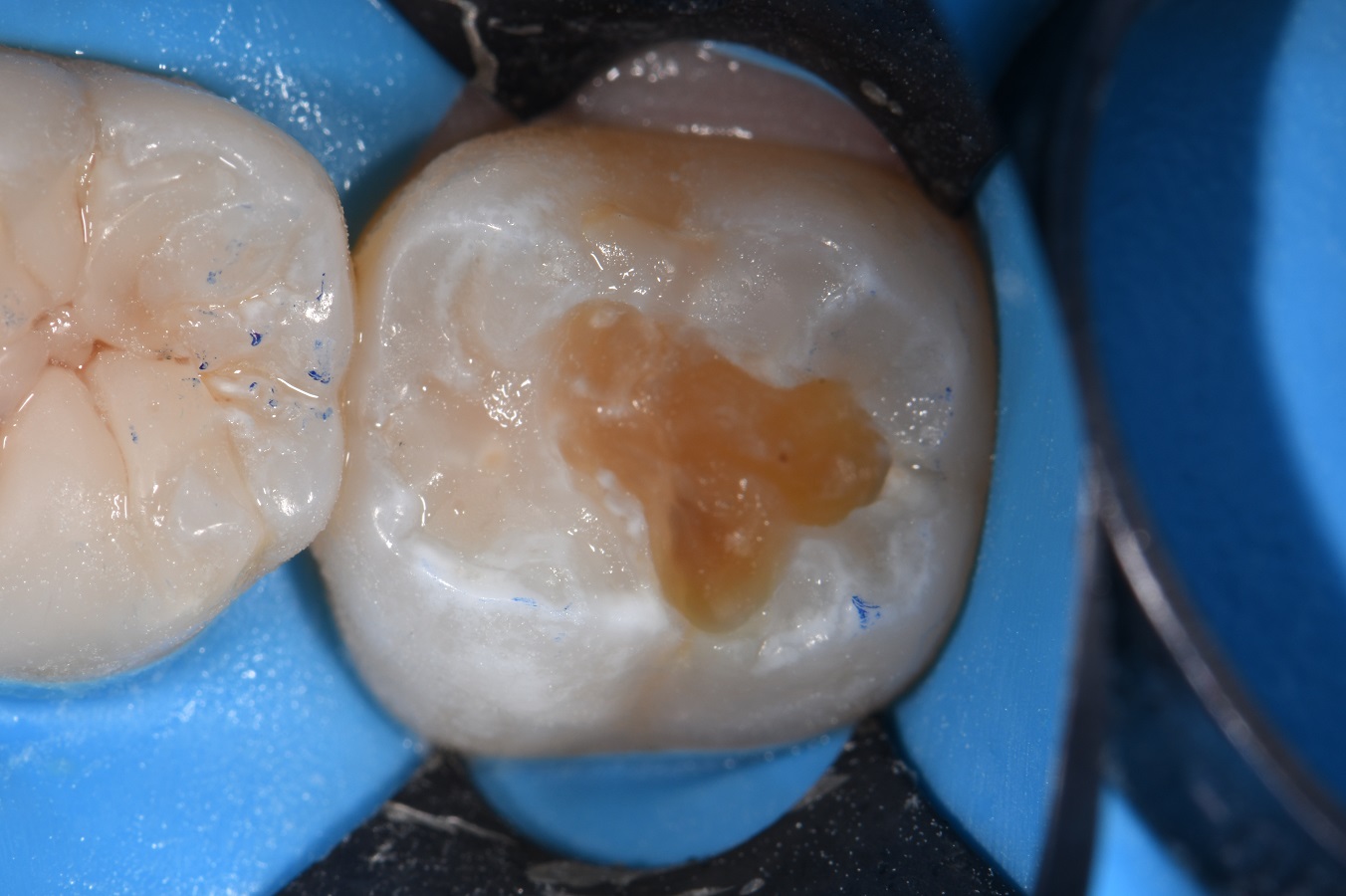 Shallow secondary caries under molar hypomineralization
