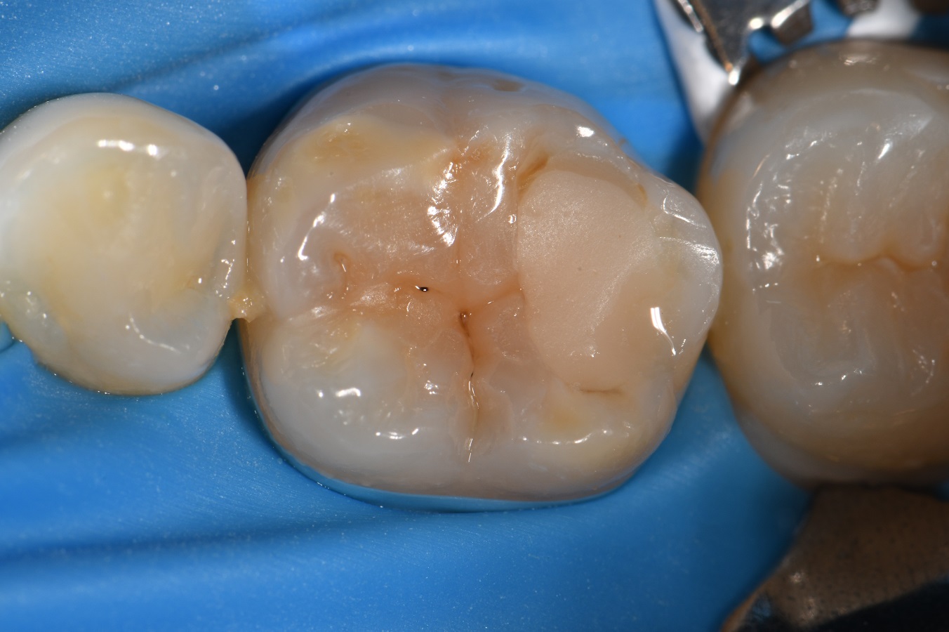 Simplishade Chameleon Effect | Molar Hypomineralization