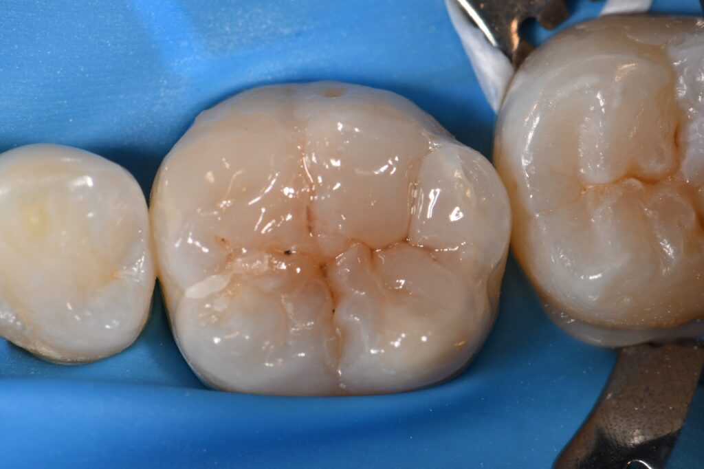 Simplishade Chameleon Effect | Molar Hypomineralization
