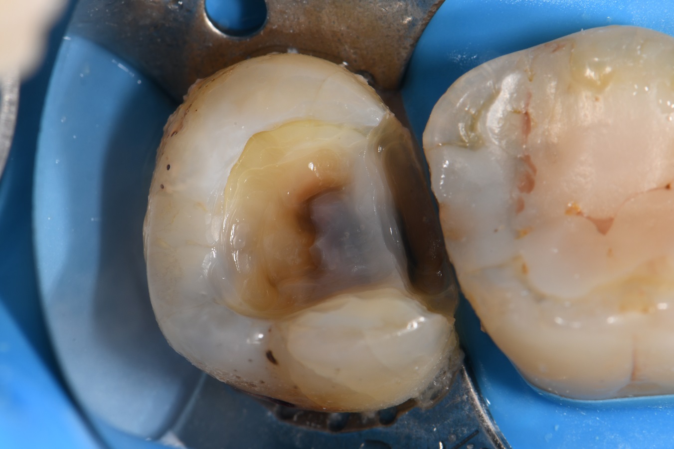 Partial Replacement of Composite Partial Replacement of Composite
