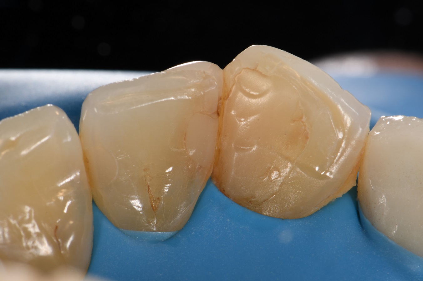 Kerr Simplishade partial Class III replacement