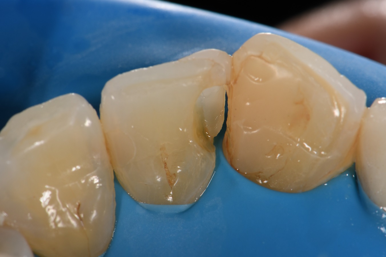 Kerr Simplishade partial Class III replacement