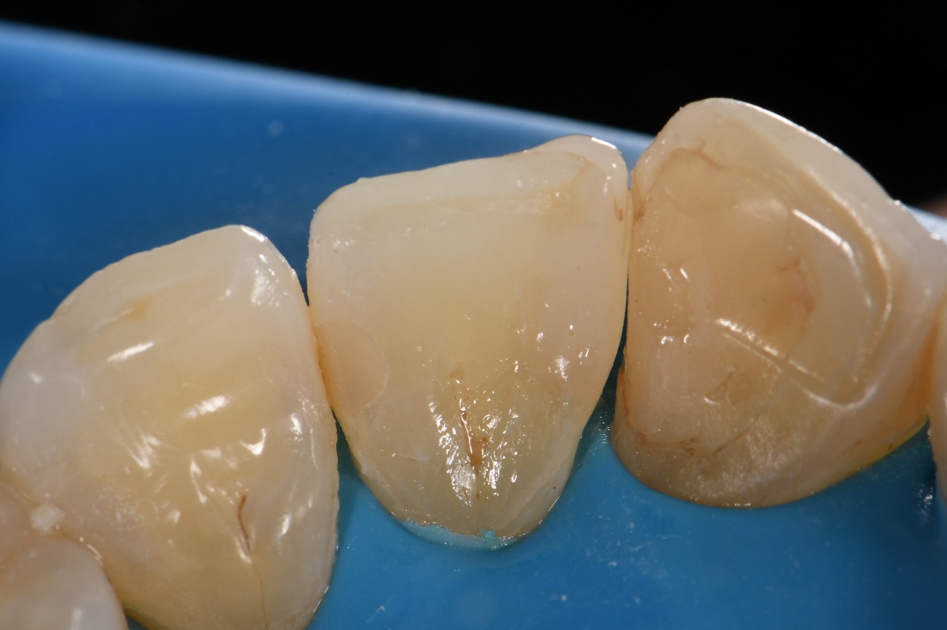 Kerr Simplishade partial Class III replacement