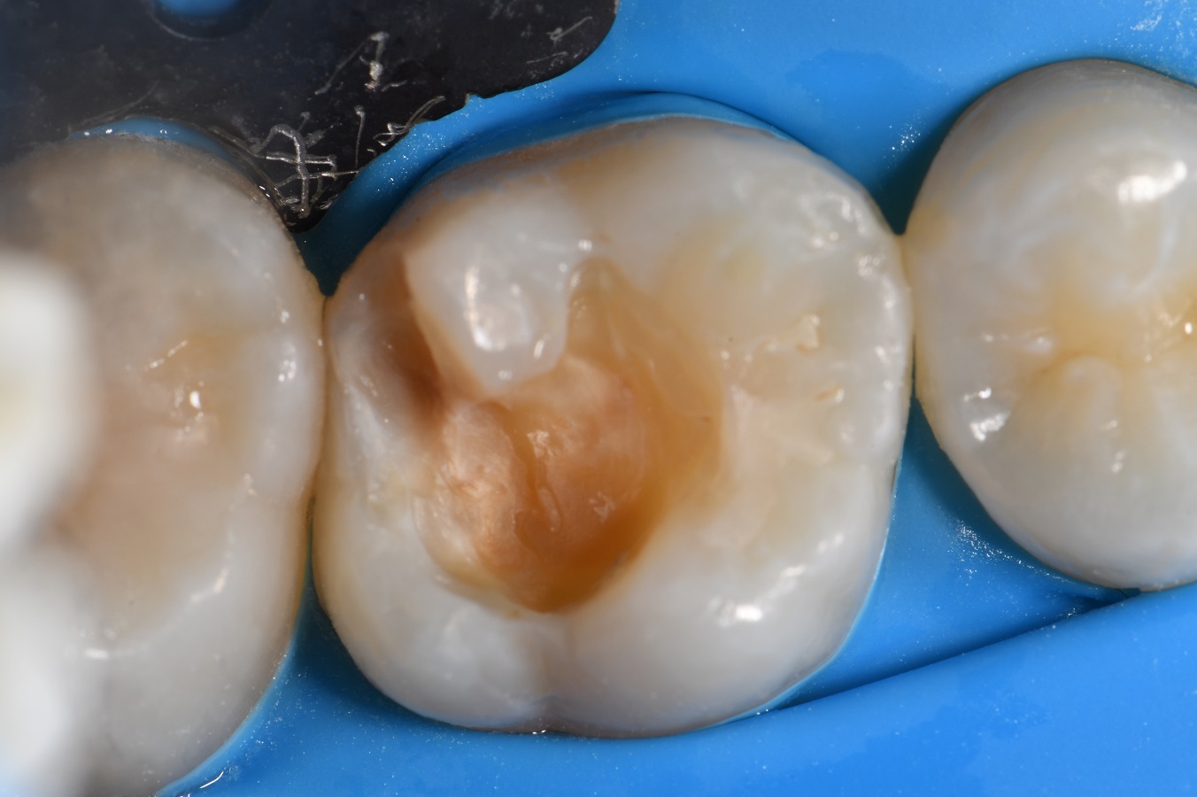 #post_titleRestoration of a Chalky Tooth