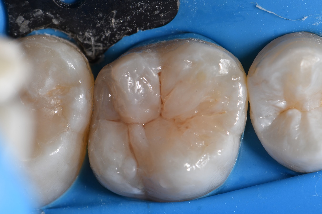 #post_titleRestoration of a Chalky Tooth