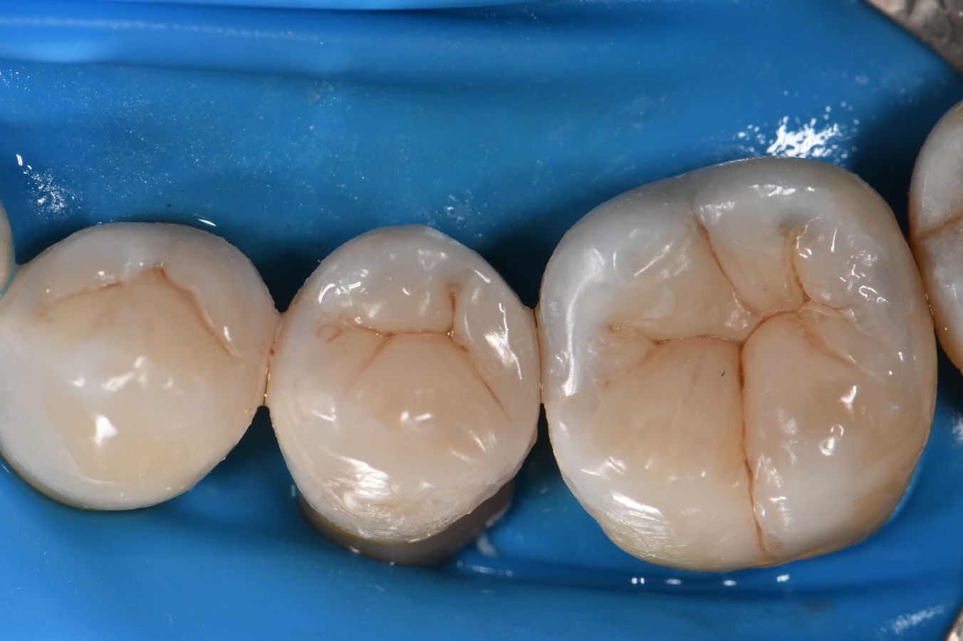 Extensive quadrant dentistry