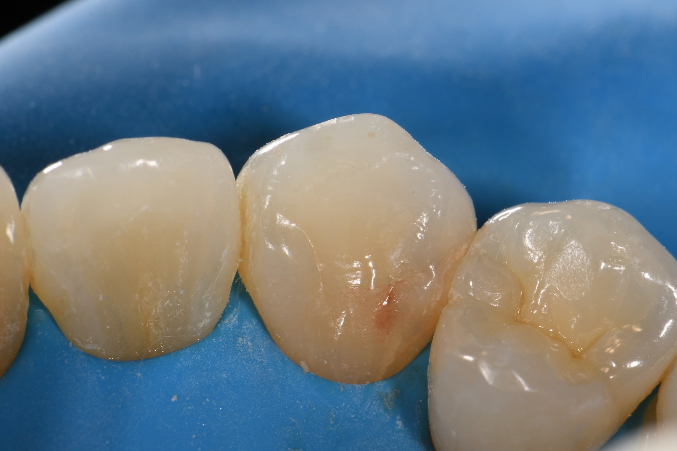 Implant Smile Makeover | Angulated Screw Channel