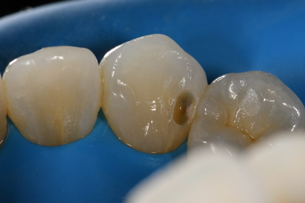 Implant Smile Makeover | Angulated Screw Channel