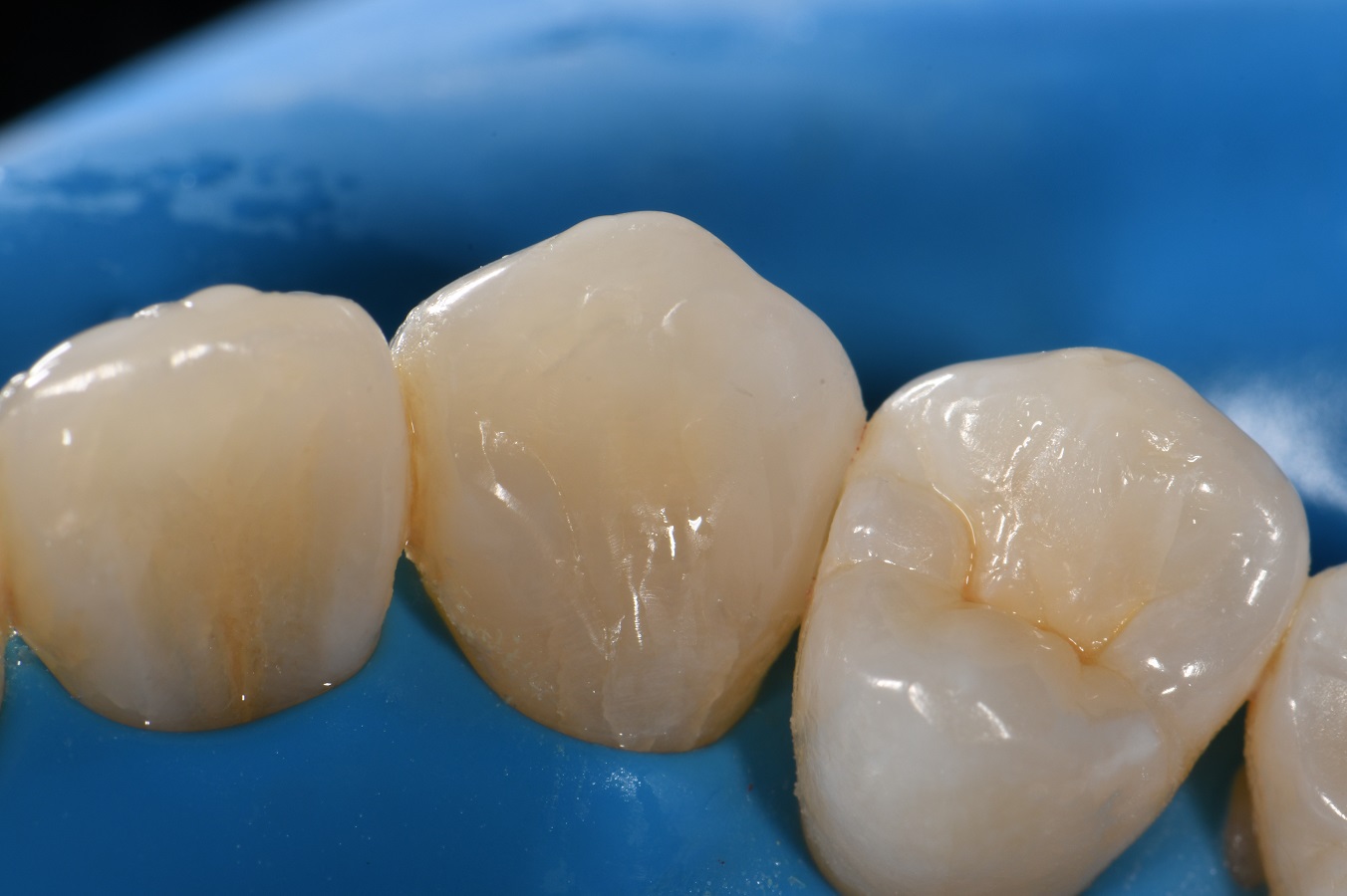 Implant Smile Makeover | Angulated Screw Channel