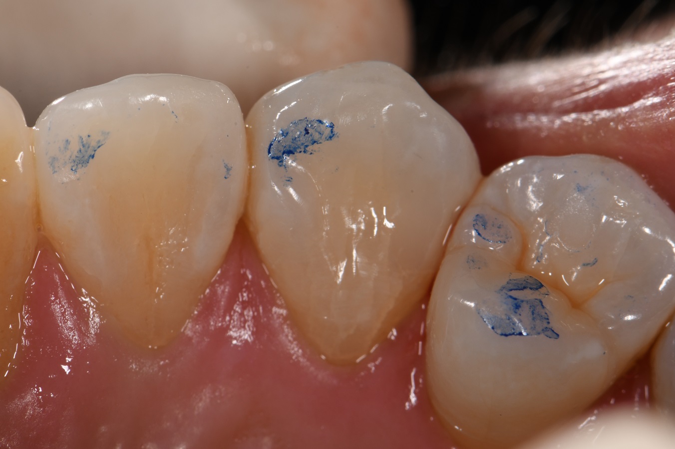 Implant Smile Makeover | Angulated Screw Channel