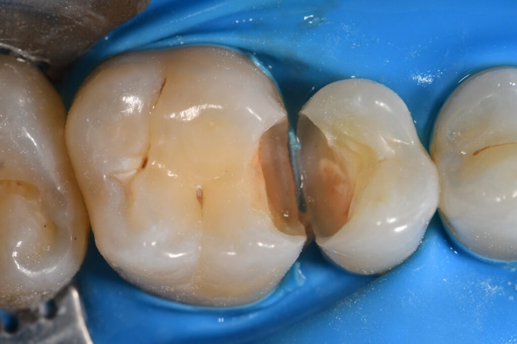 Back to Back Class II composite workflow