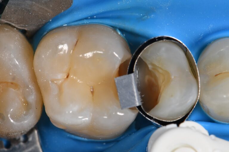 Back to Back Class II composite workflow