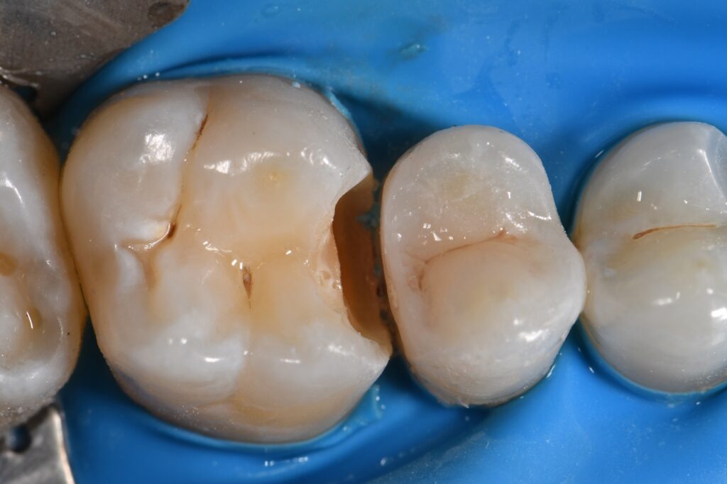 Back to Back Class II composite workflow