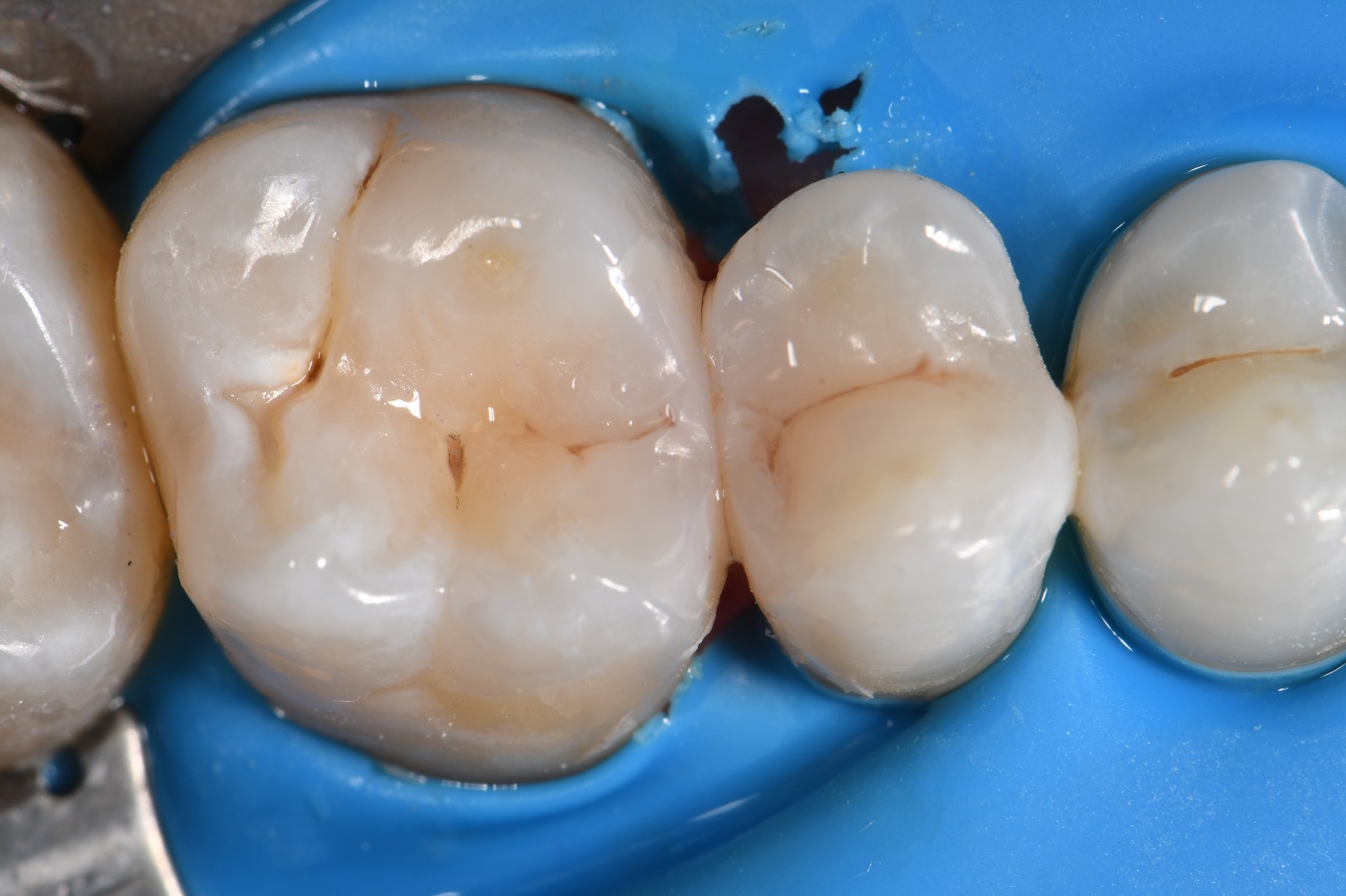 Back to Back Class II composite workflow