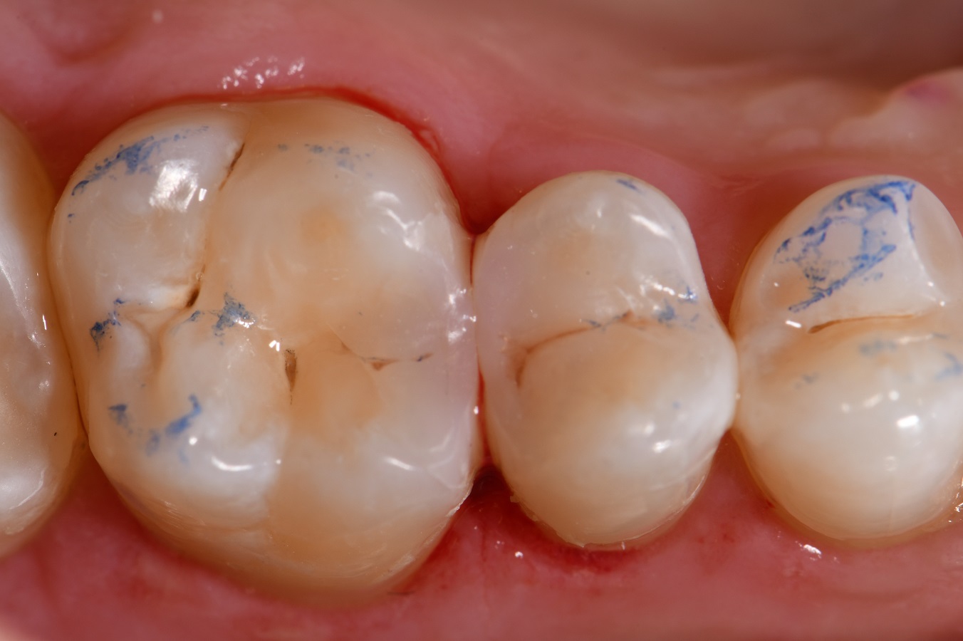 Back to Back Class II composite workflow