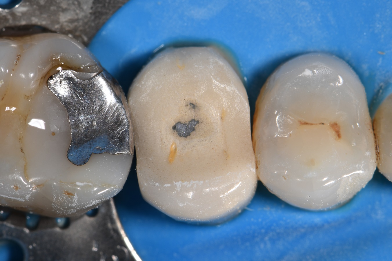 Rebuilding BioBases in fracture prone teeth
