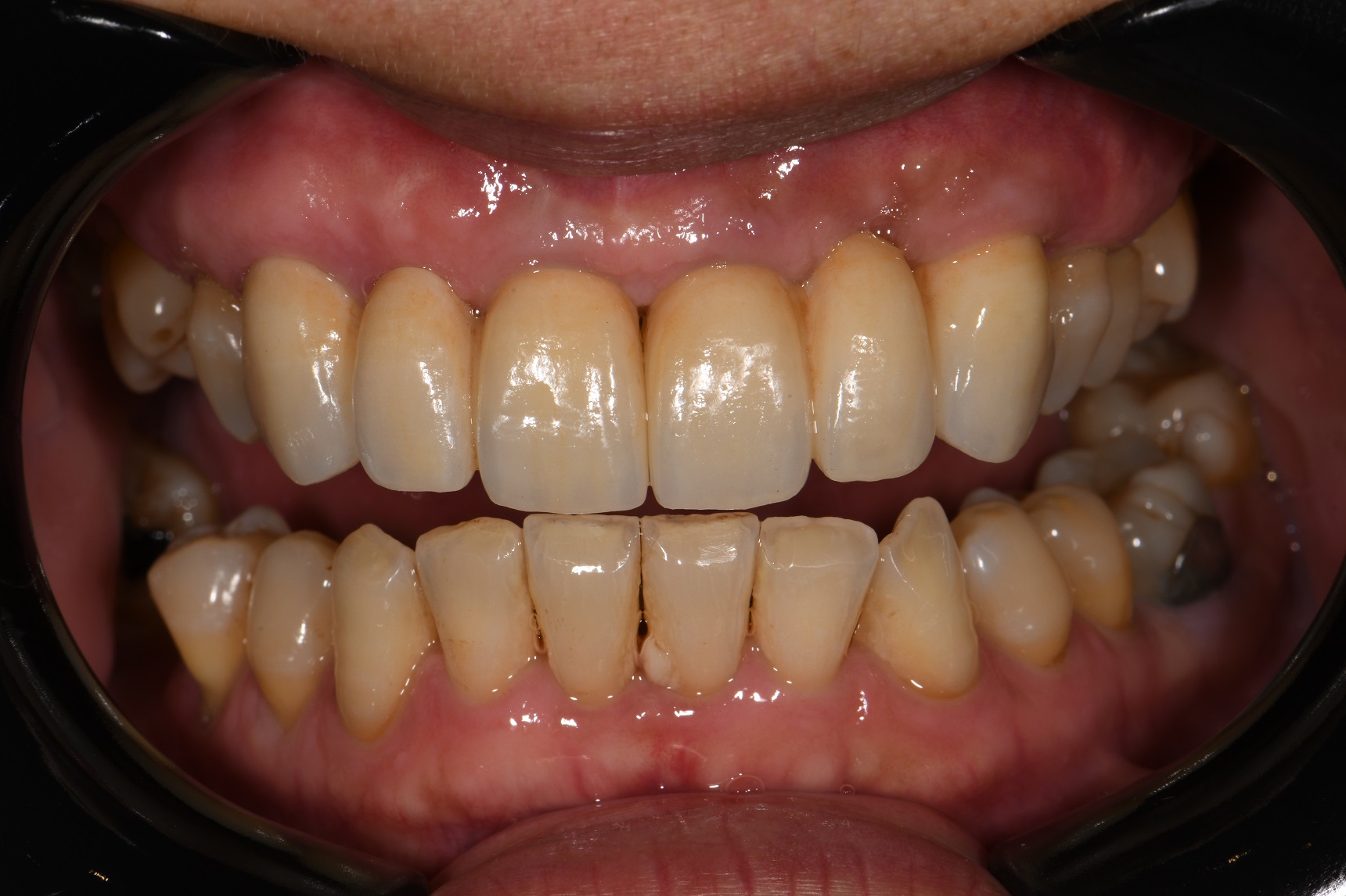 Replacement of a hopeless anterior bridge with implants