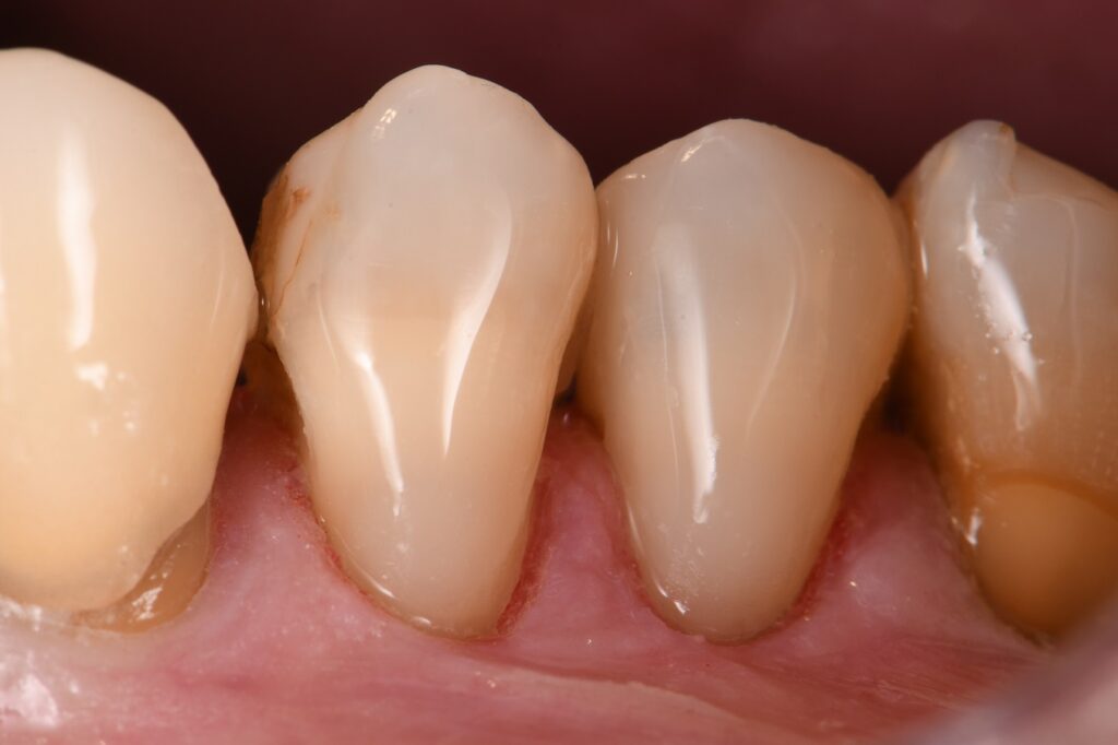 GC Essentia U composite restorations